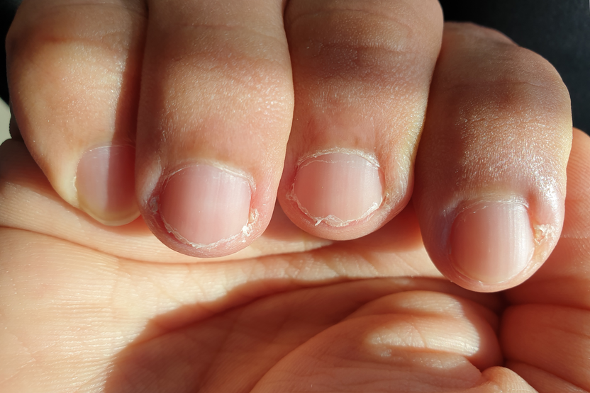 Signs of Vitamin Deficiency in Nails – HealthyCell